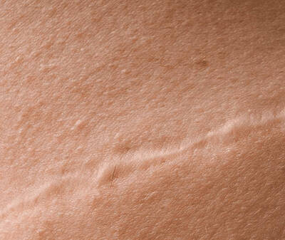 scar skin texture