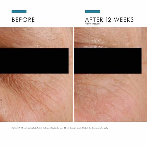 A.G.E Eye Complex: Eye Cream for Dark Circles & Wrinkles | SkinCeuticals