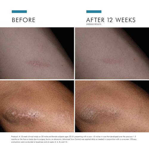 Advanced Scar Control | Scar Gel For Body | SkinCeuticals