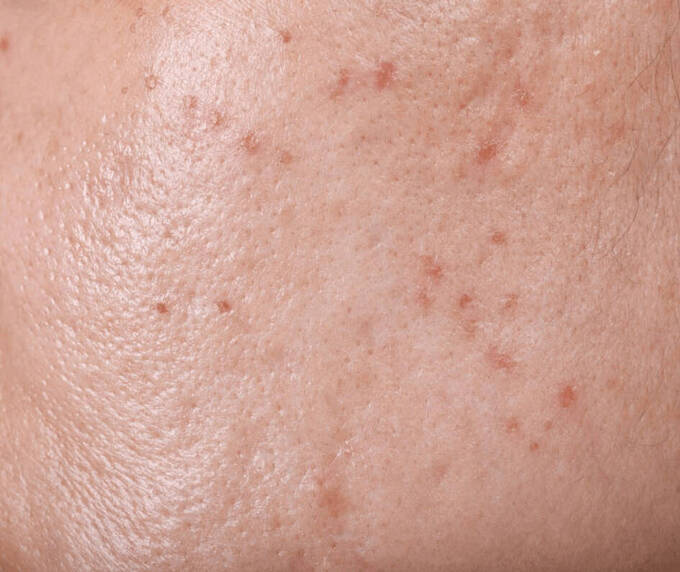 Blemish + Age Defense Serum | Salicylic Acid | SkinCeuticals